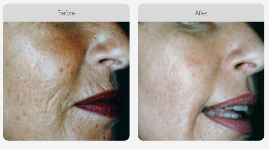 Looking for Botox Alternatives? Try These Non-Invasive Beauty ...